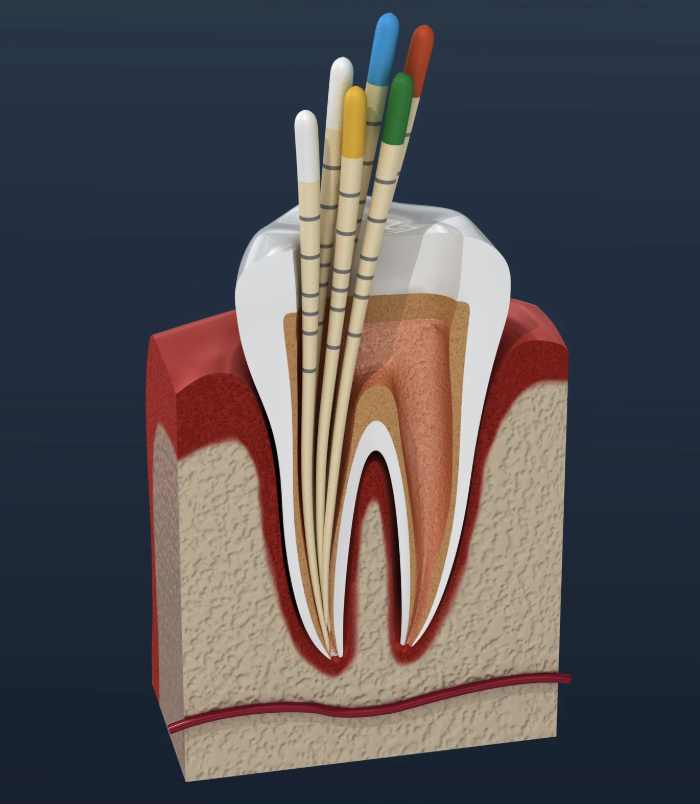 How to use apex locator to determine working length? - Best Dental Co., Ltd